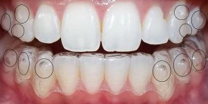 Invisalign opiniones: 15 cosas que todo paciente debe saber